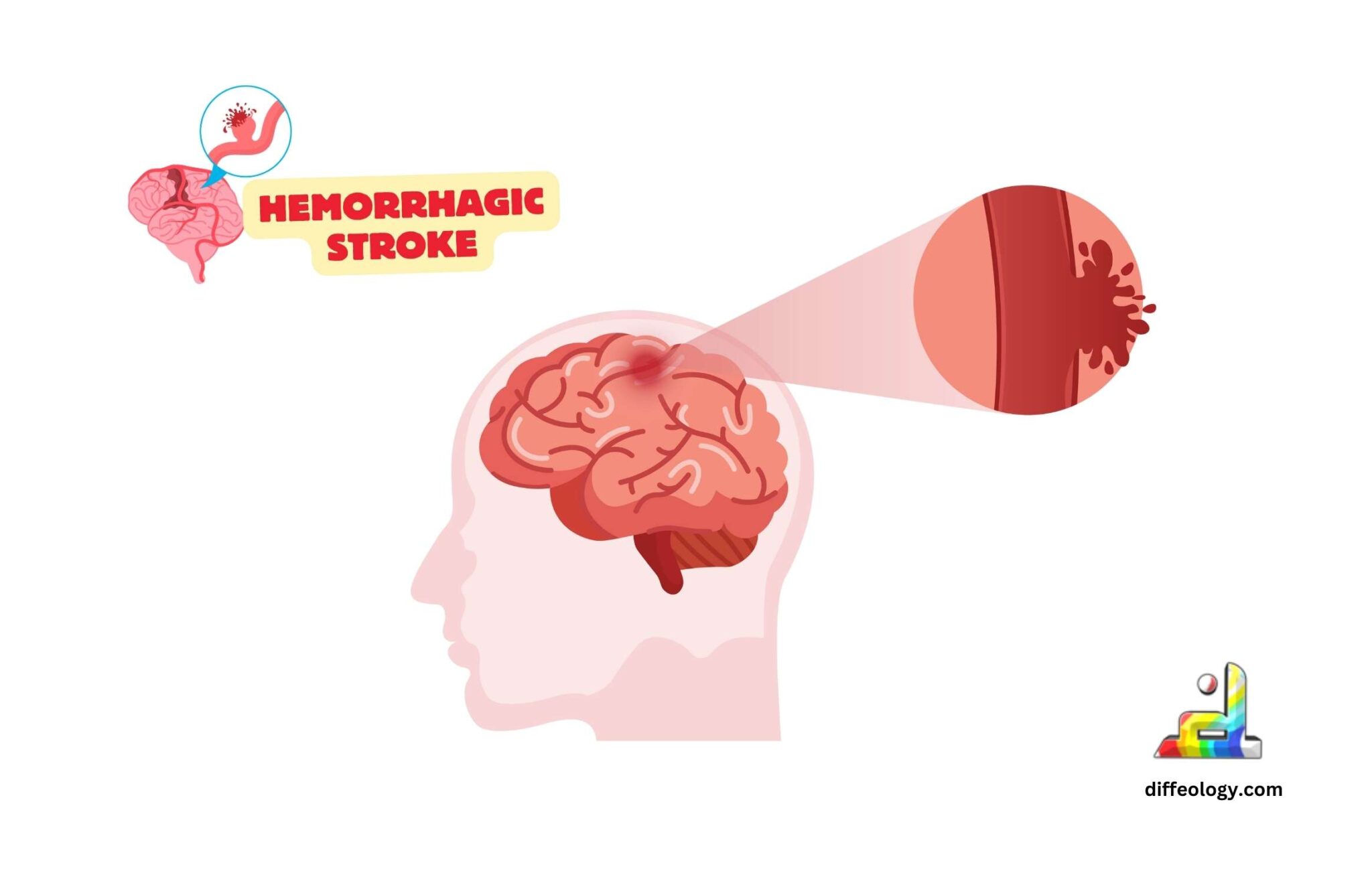 Difference Between Ischemic And Hemorrhagic Stroke | Diffeology