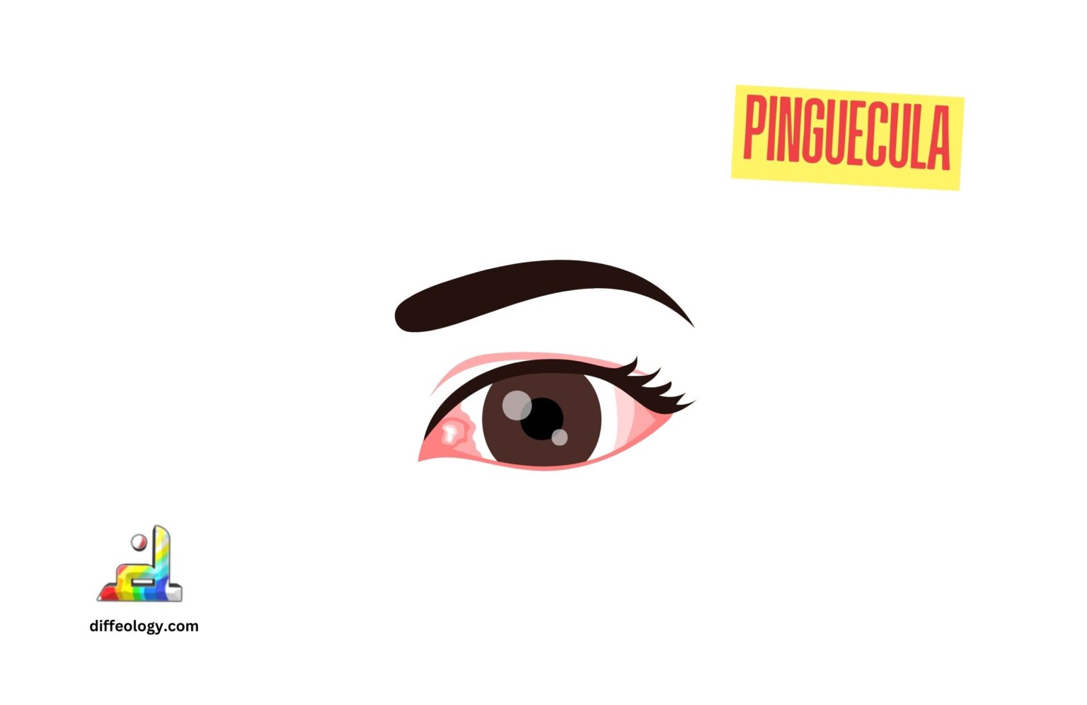 Difference Between Pinguecula And Pterygium | Diffeology